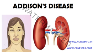 ADDISON’S DISEASE (ADRENAL INSUFFICIENCY) - Nurse Info
