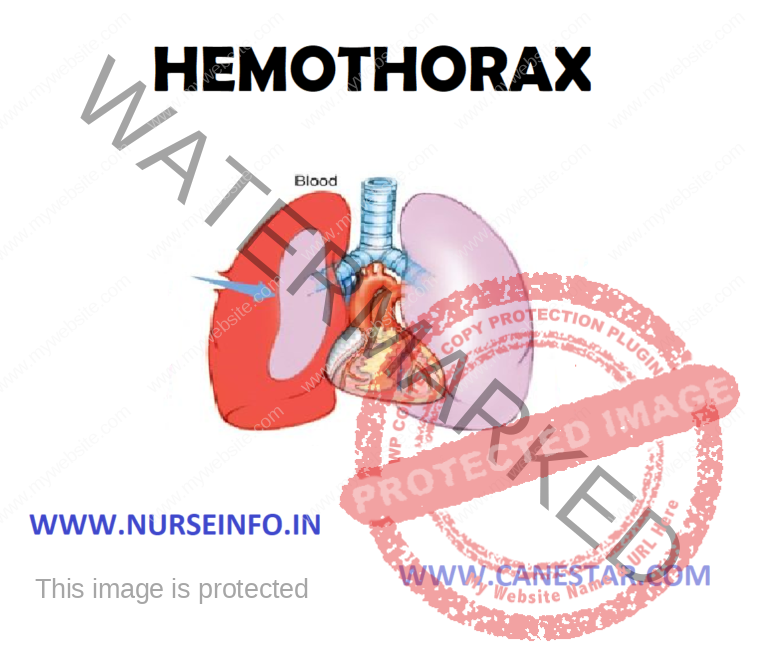 HEMOTHORAX - Nurse Info %post_title% | NurseInfo Nursing Notes