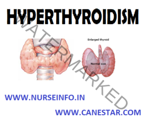 HYPERTHYROIDISM - Nurse Info