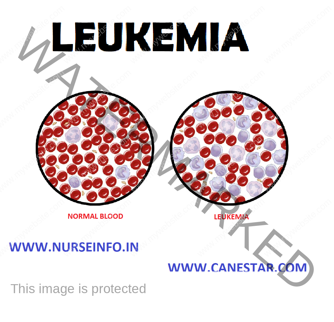 LEUKEMIA - Nurse Info