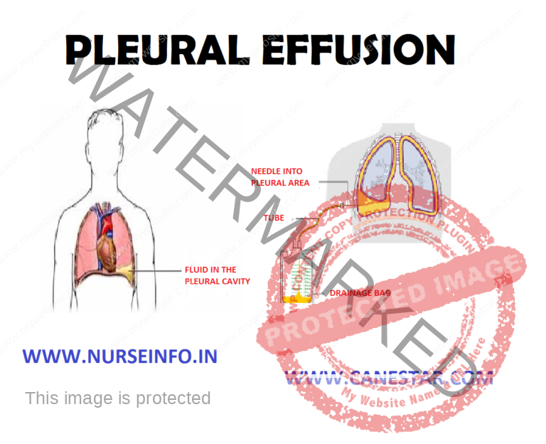 PLEURAL EFFUSION - Nurse Info