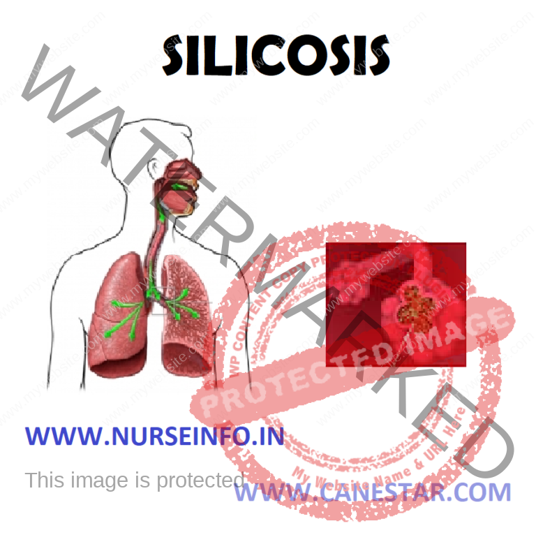 SILICOSIS - Nurse Info