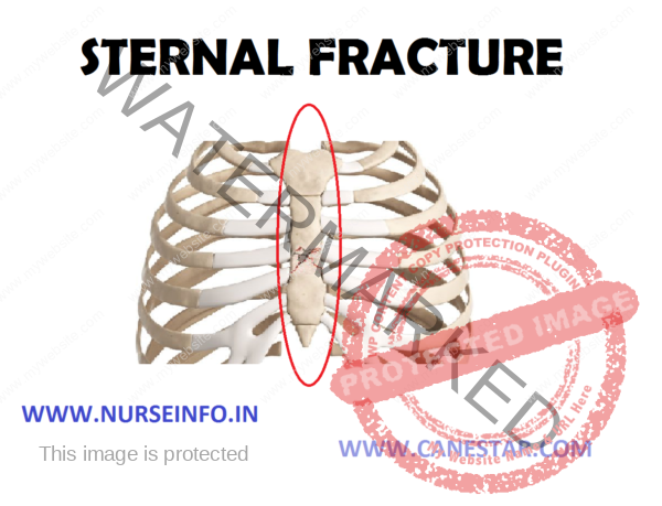 STERNAL FRACTURE - Nurse Info