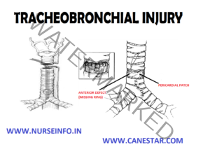 TRACHEOBRONCHIAL INJURY - Nurse Info