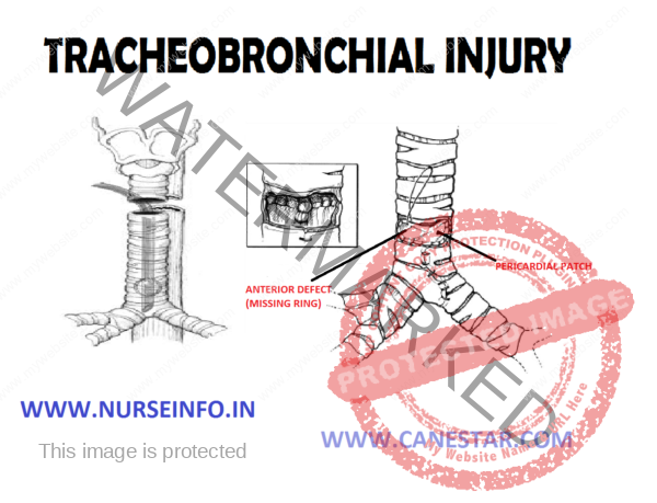 TRACHEOBRONCHIAL INJURY - Nurse Info