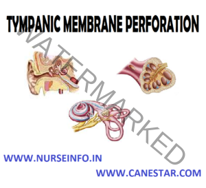 TYMPANIC MEMBRANE PERFORATION - Nurse Info %post_title% | NurseInfo ...