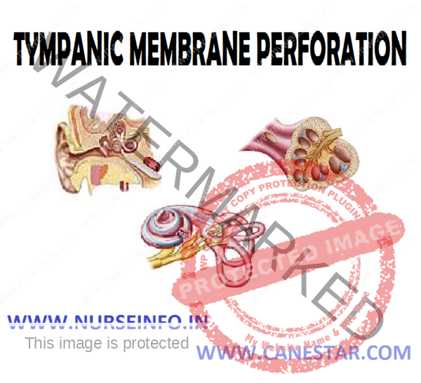 TYMPANIC MEMBRANE PERFORATION - Nurse Info