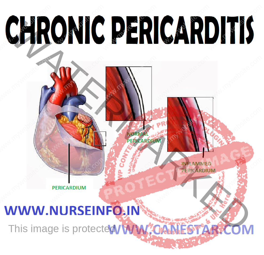 CHRONIC PERICARDITIS - Nurse Info