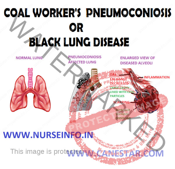 COAL WORKER’S PNEUMOCONIOSIS - Nurse Info