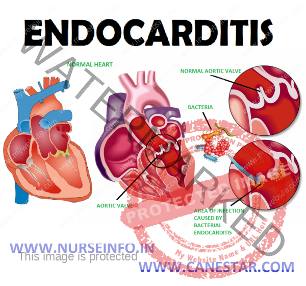 ENDOCARDITIS - Nurse Info
