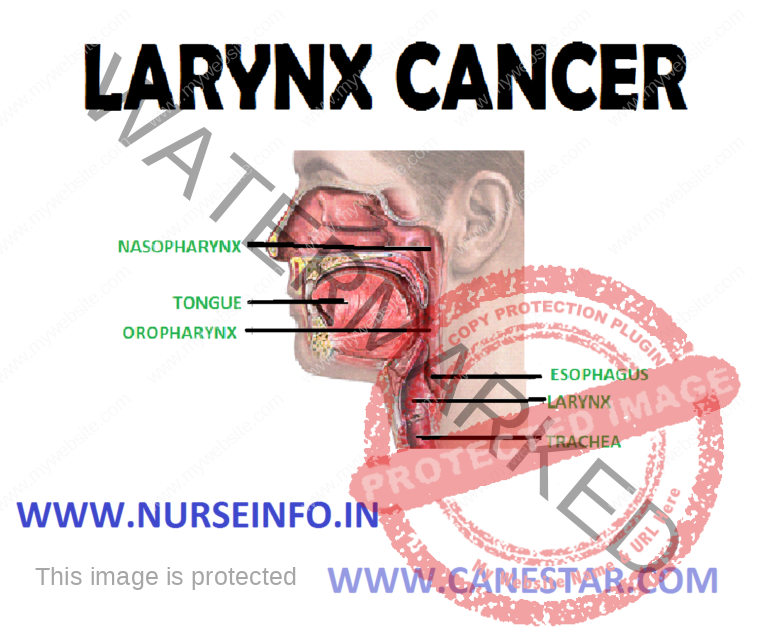 LARYNX CANCER - Nurse Info
