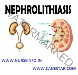 NEPHROLITHIASIS - Nurse Info