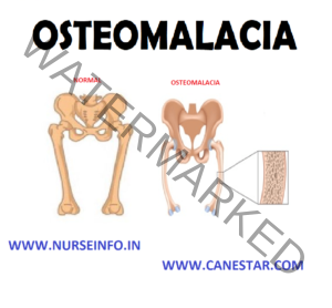 OSTEOMALACIA - Nurse Info
