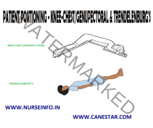 PATIENT POSITIONING – KNEE-CHEST/GENUPECTORAL & TRENDELENBURG’S ...