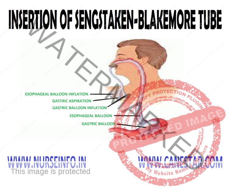 INSERTION OF SENGSTAKEN-BLAKEMORE (SB) TUBE BALLOON TAMPONADE - Nurse Info