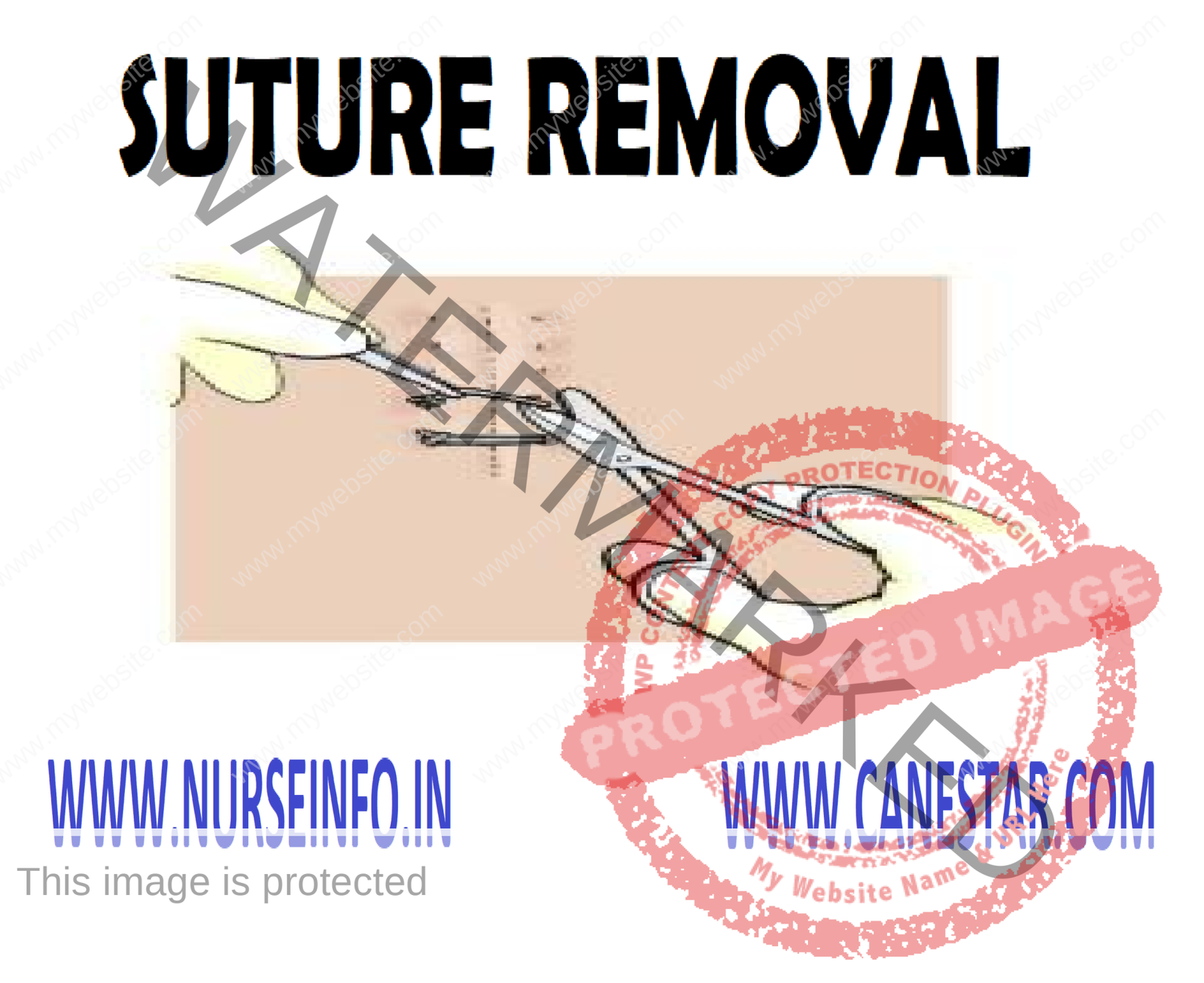 SUTURE REMOVAL | Nurse Info