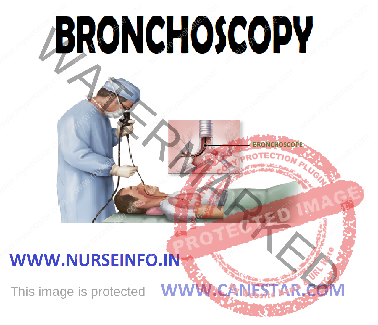 BRONCHOSCOPY - Nurse Info