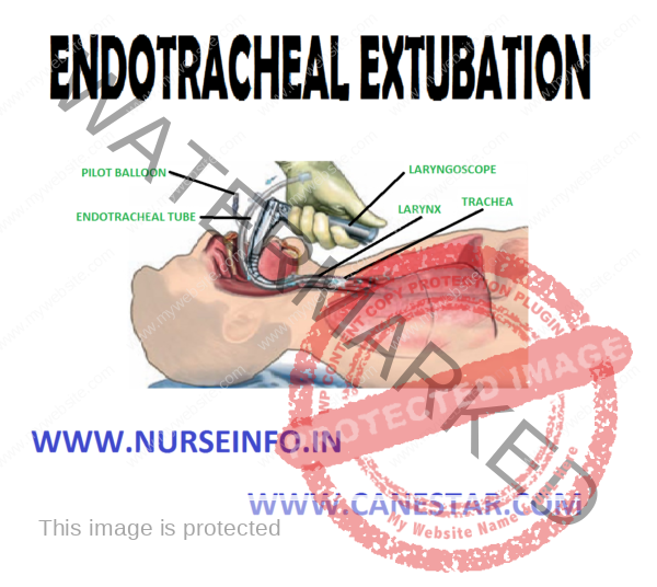 ENDOTRACHEAL EXTUBATION - Nurse Info