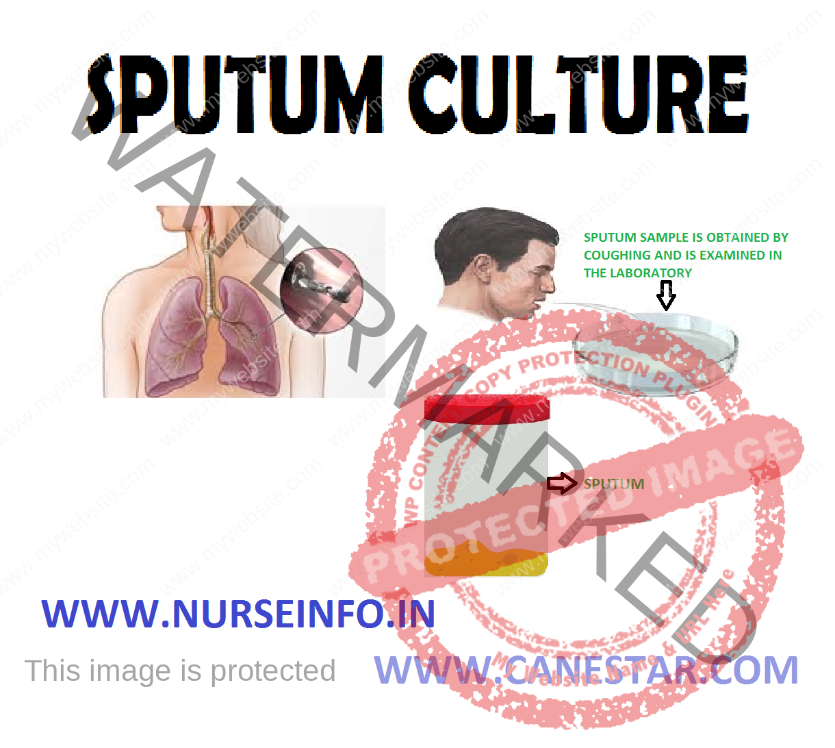 SPUTUM CULTURE Nurse Info SPUTUM CULTURE Nurse Info