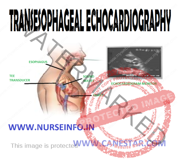 TRANSESOPHAGEAL ECHOCARDIOGRAPHY - Nurse Info %post_title% | NurseInfo ...