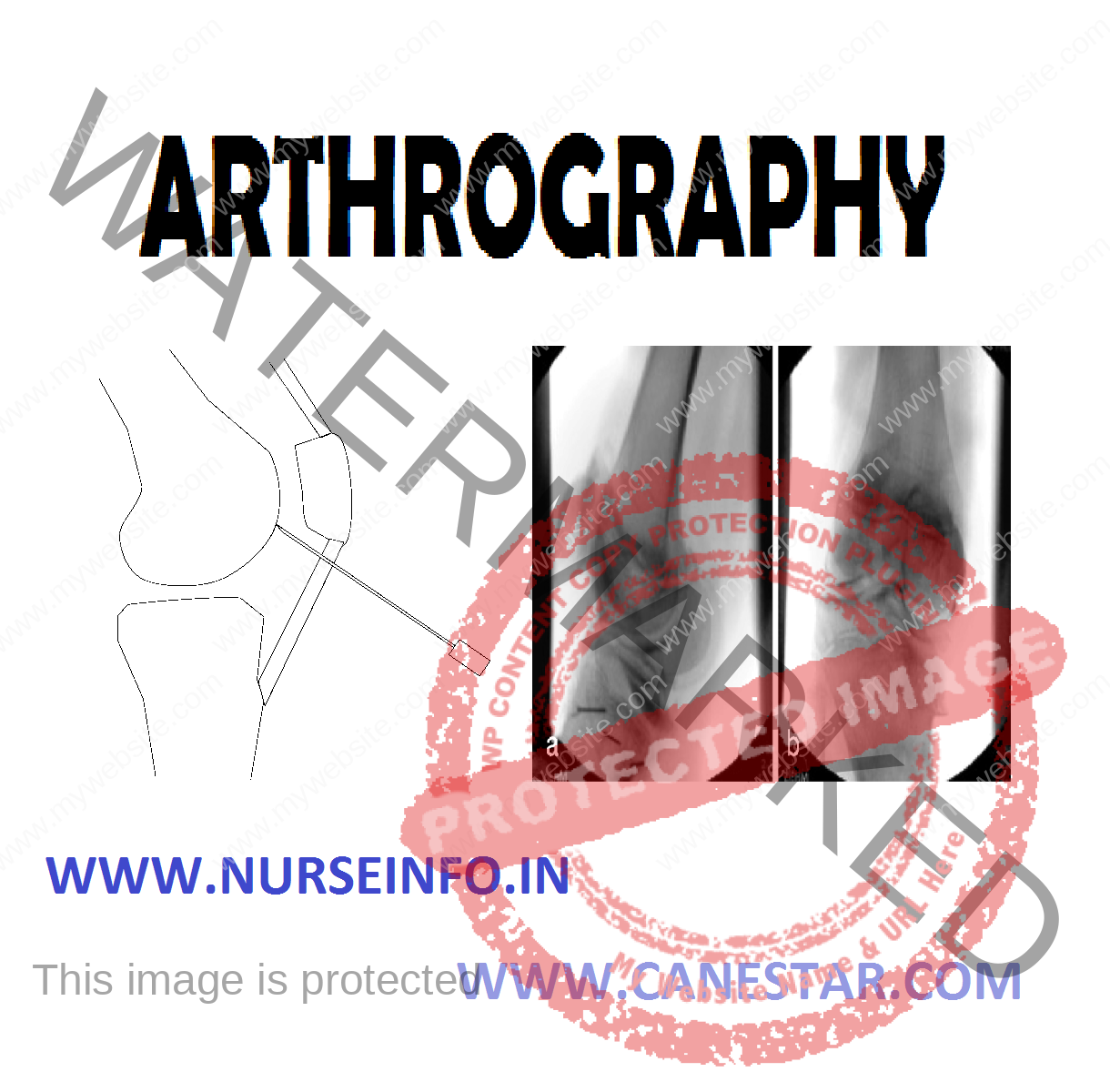 ARTHROGRAPHY - Nurse Info
