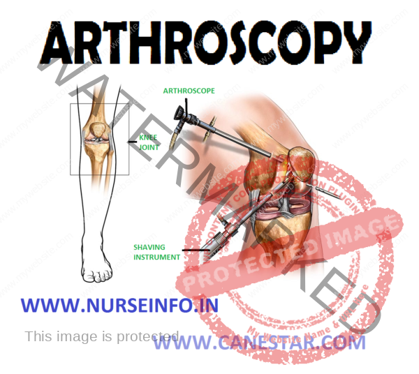 ARTHROSCOPY - Nurse Info