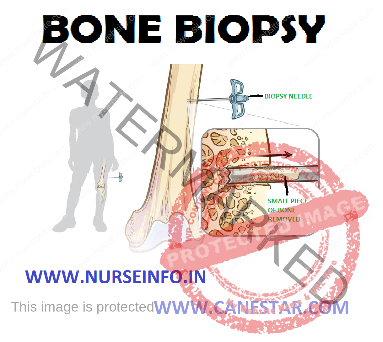 BONE BIOPSY - Nurse Info