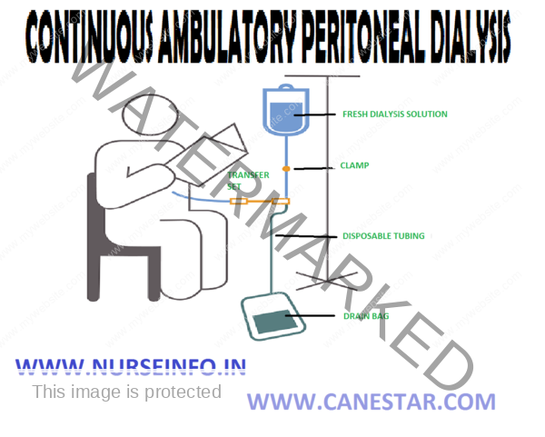 CONTINUOUS AMBULATORY PERITONEAL DIALYSIS - Nurse Info