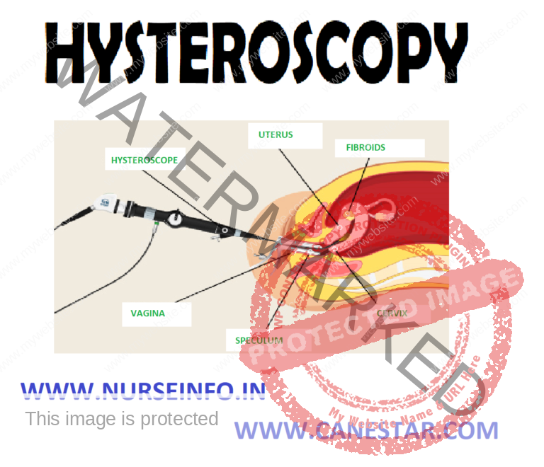 HYSTEROSCOPY - Nurse Info