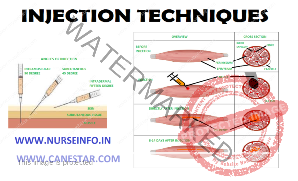 INJECTION TECHNIQUE - Nurse Info