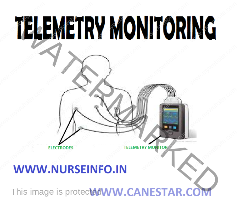 TELEMETRY MONITORING - Nurse Info
