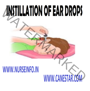 INSTILLATION OF EAR DROPS - Nurse Info