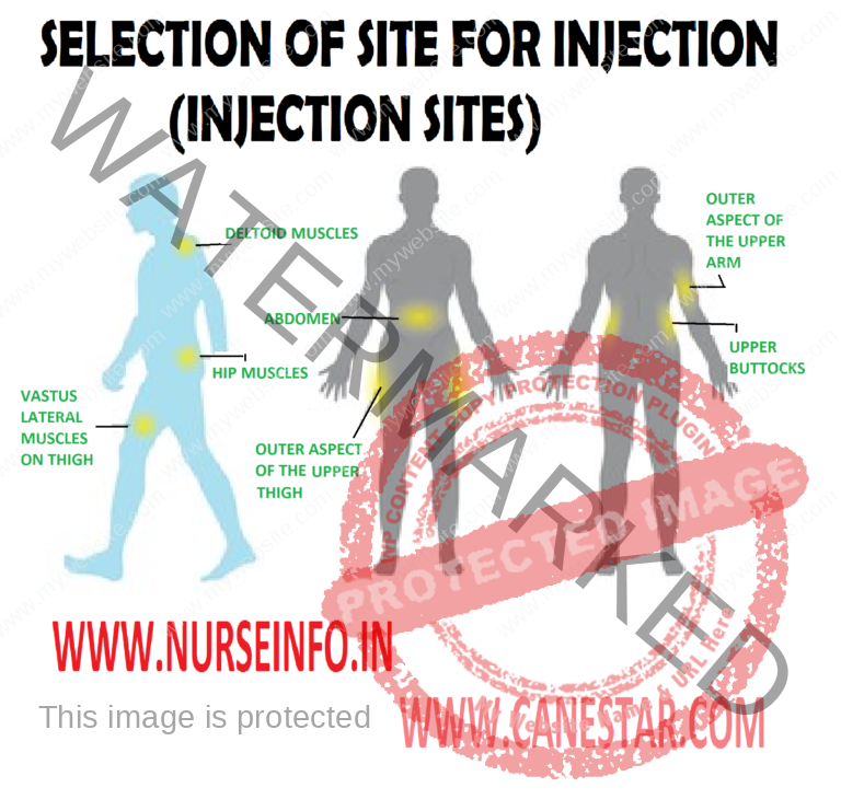 SELECTION OF SITE FOR INJECTION - Nurse Info