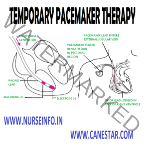 TEMPORARY PACEMAKER THERAPY - Nurse Info