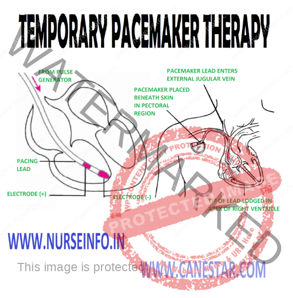 TEMPORARY PACEMAKER THERAPY - Nurse Info