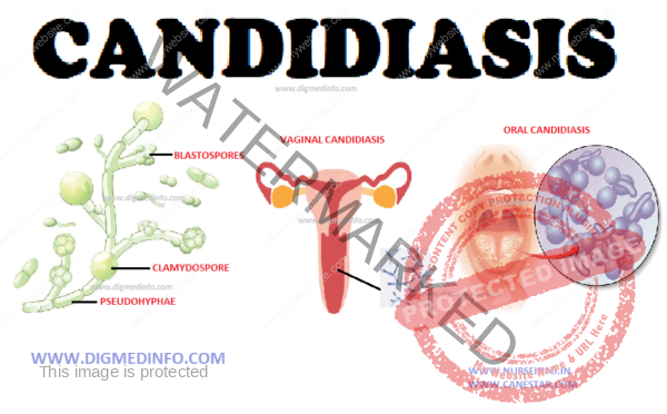CANDIDIASIS – General Characteristics, Diagnosis and Treatment | Nurse Info