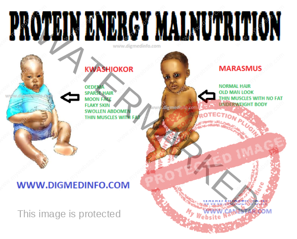 PROTEIN ENERGY MALNUTRITION – General Characteristics, Etiology and ...